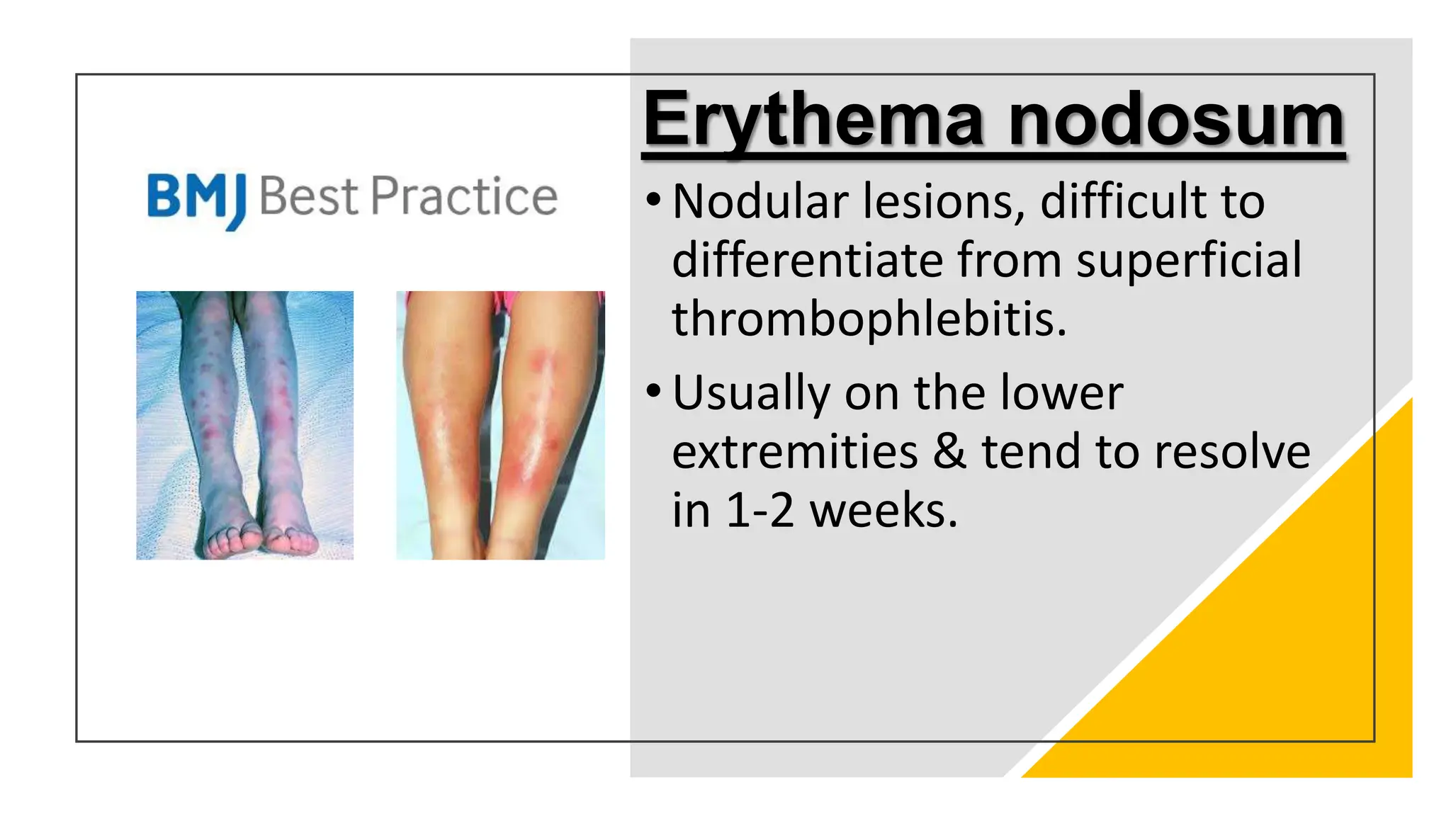 Subcutaneous nodules in rheumatic diseases Ahmed Yehia Assistant ...