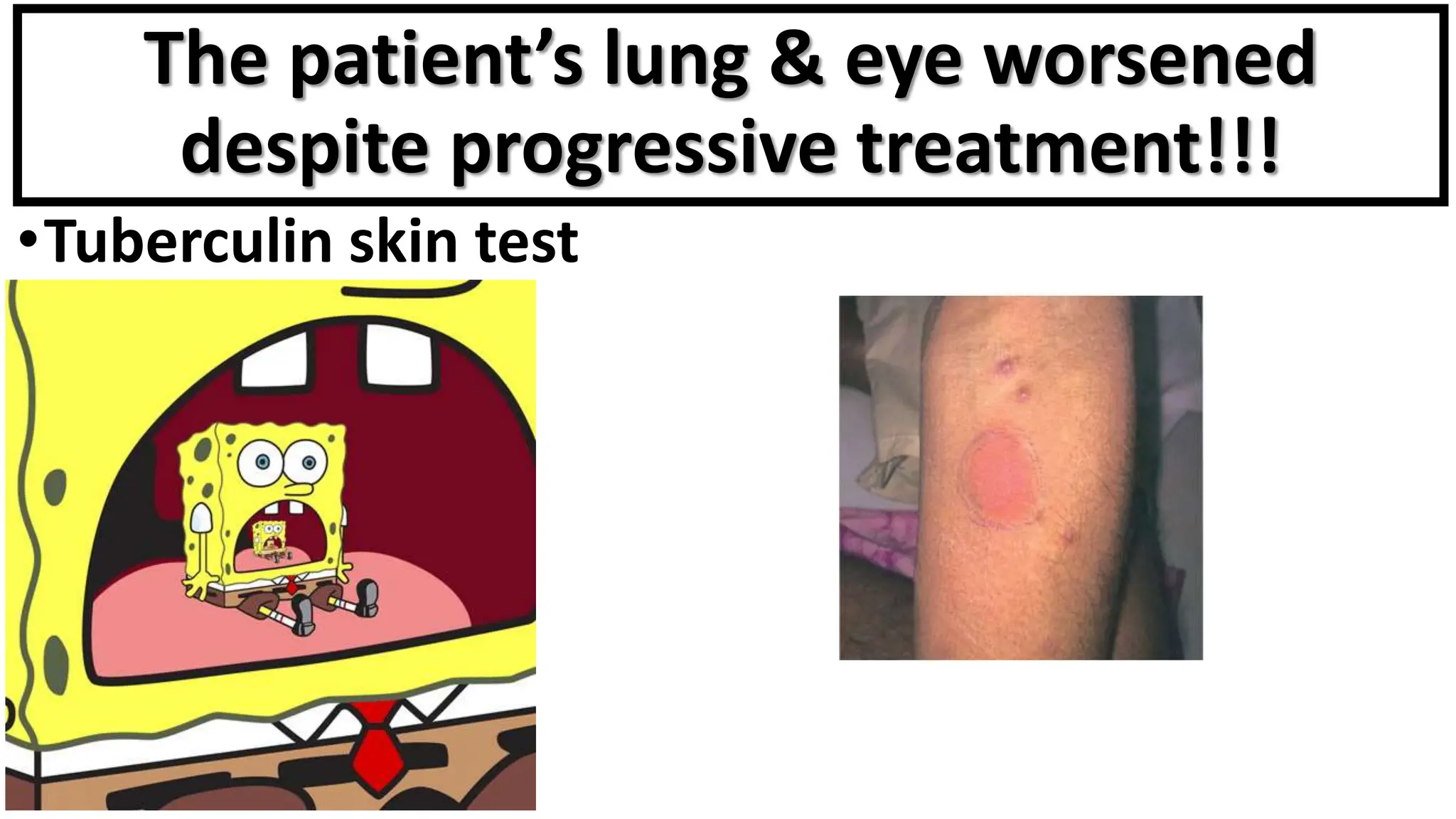 Subcutaneous nodules in rheumatic diseases Ahmed Yehia Assistant ...