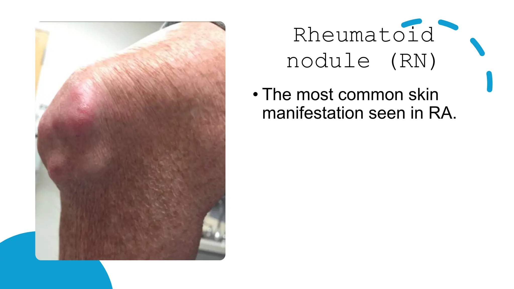 Subcutaneous nodules in rheumatic diseases Ahmed Yehia Assistant ...