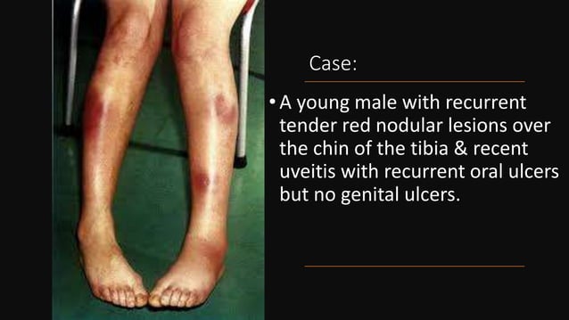 Subcutaneous nodules in rheumatic diseases Ahmed Yehia Assistant ...
