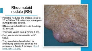 Subcutaneous nodules in rheumatic diseases Ahmed Yehia Assistant ...