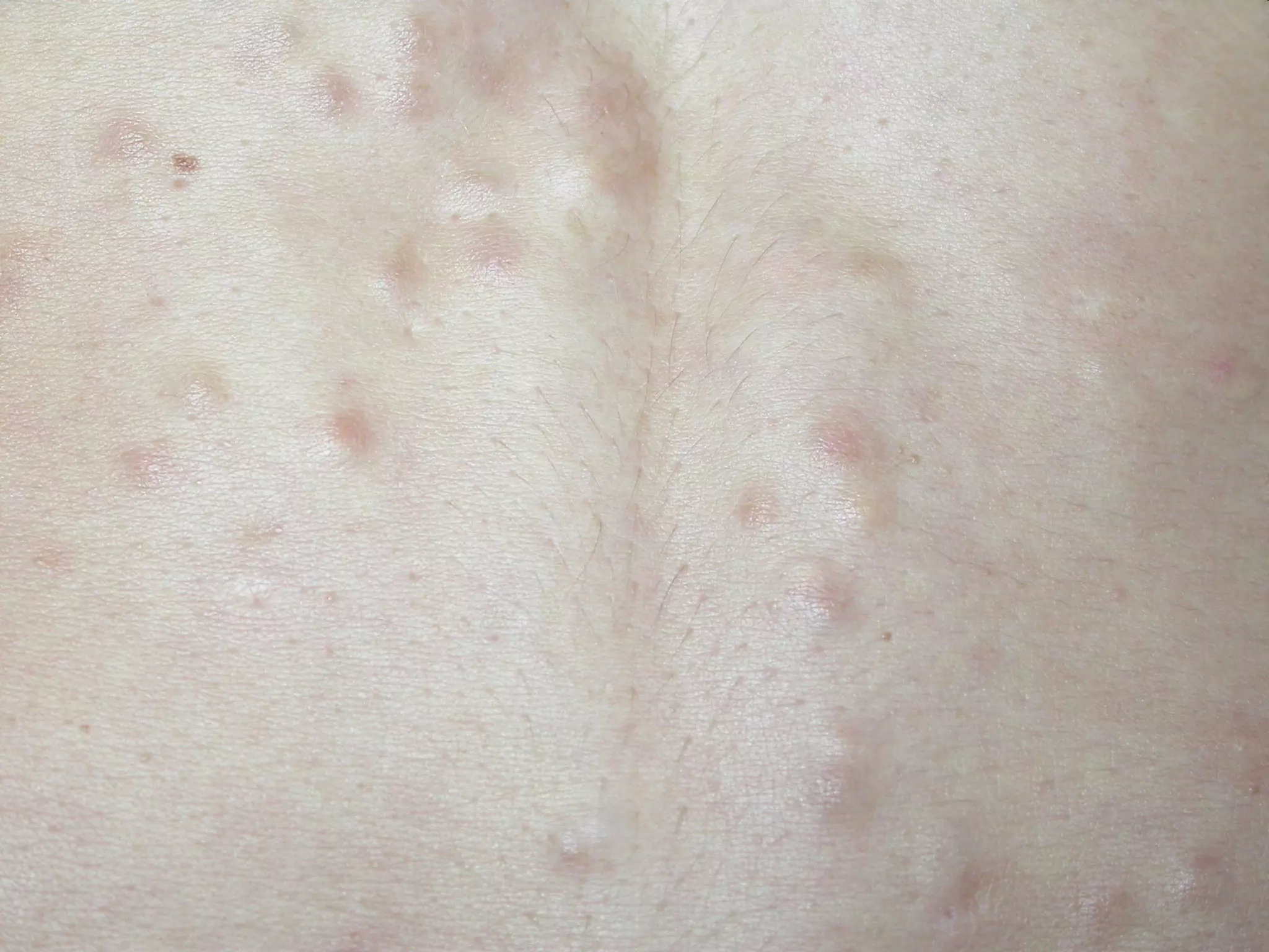 Subcutaneous nodules on the abdomen | PPT