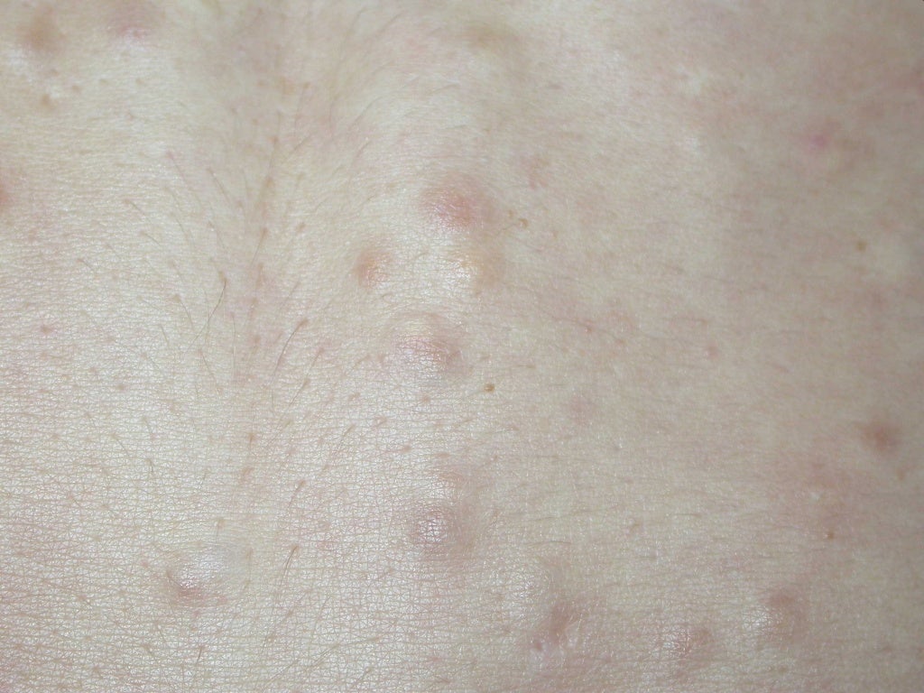 Subcutaneous nodules on the abdomen