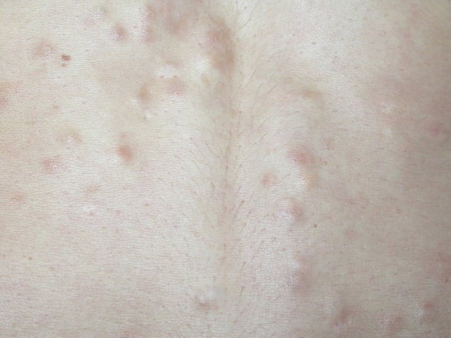 Subcutaneous nodules on the abdomen. | PPT | Skin and Dermatology ...