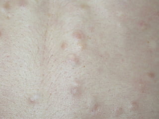 Subcutaneous nodules on the abdomen. | PPT | Skin and Dermatology ...