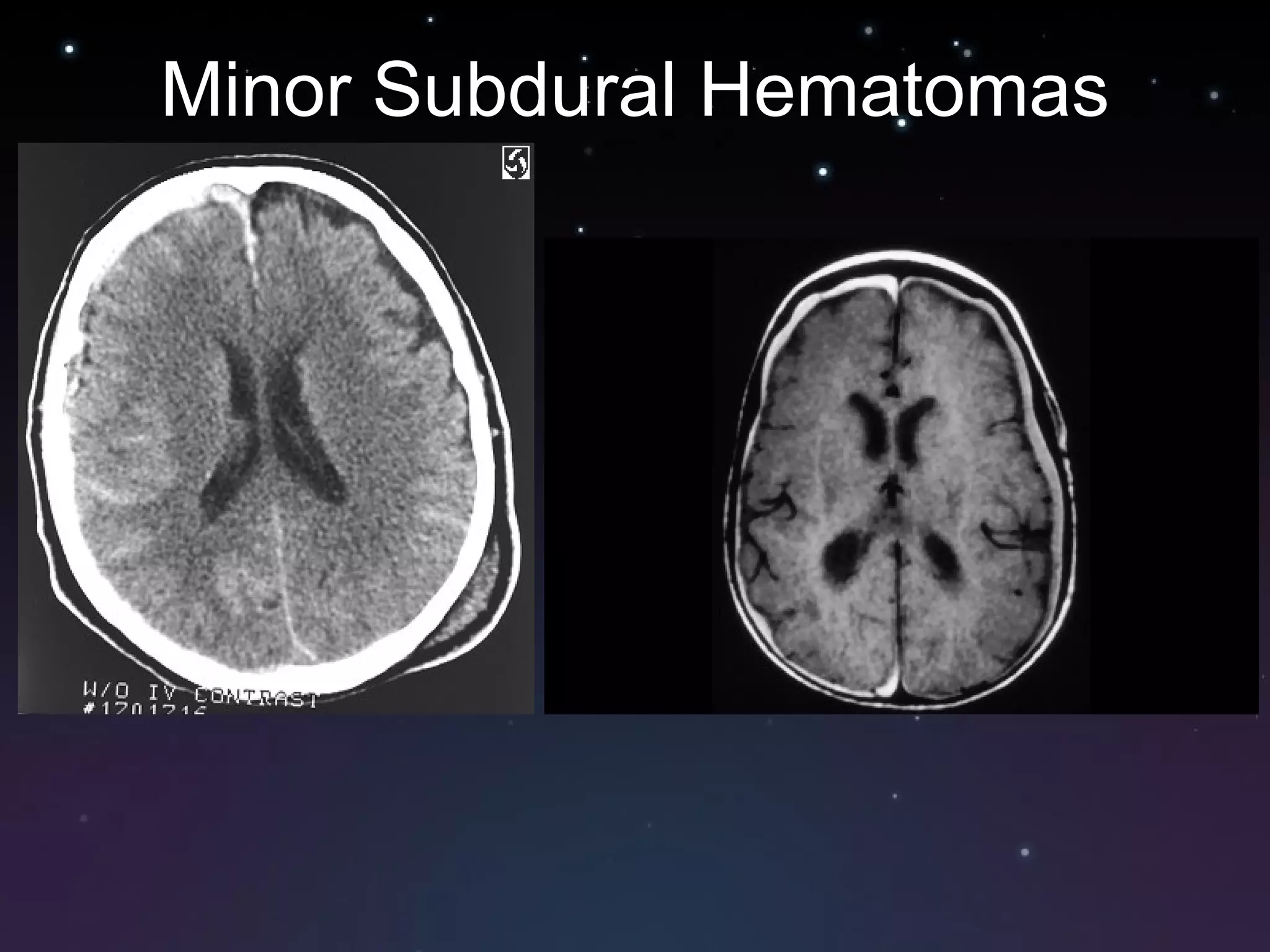 Subdural And Epidural Hematomas | PPT