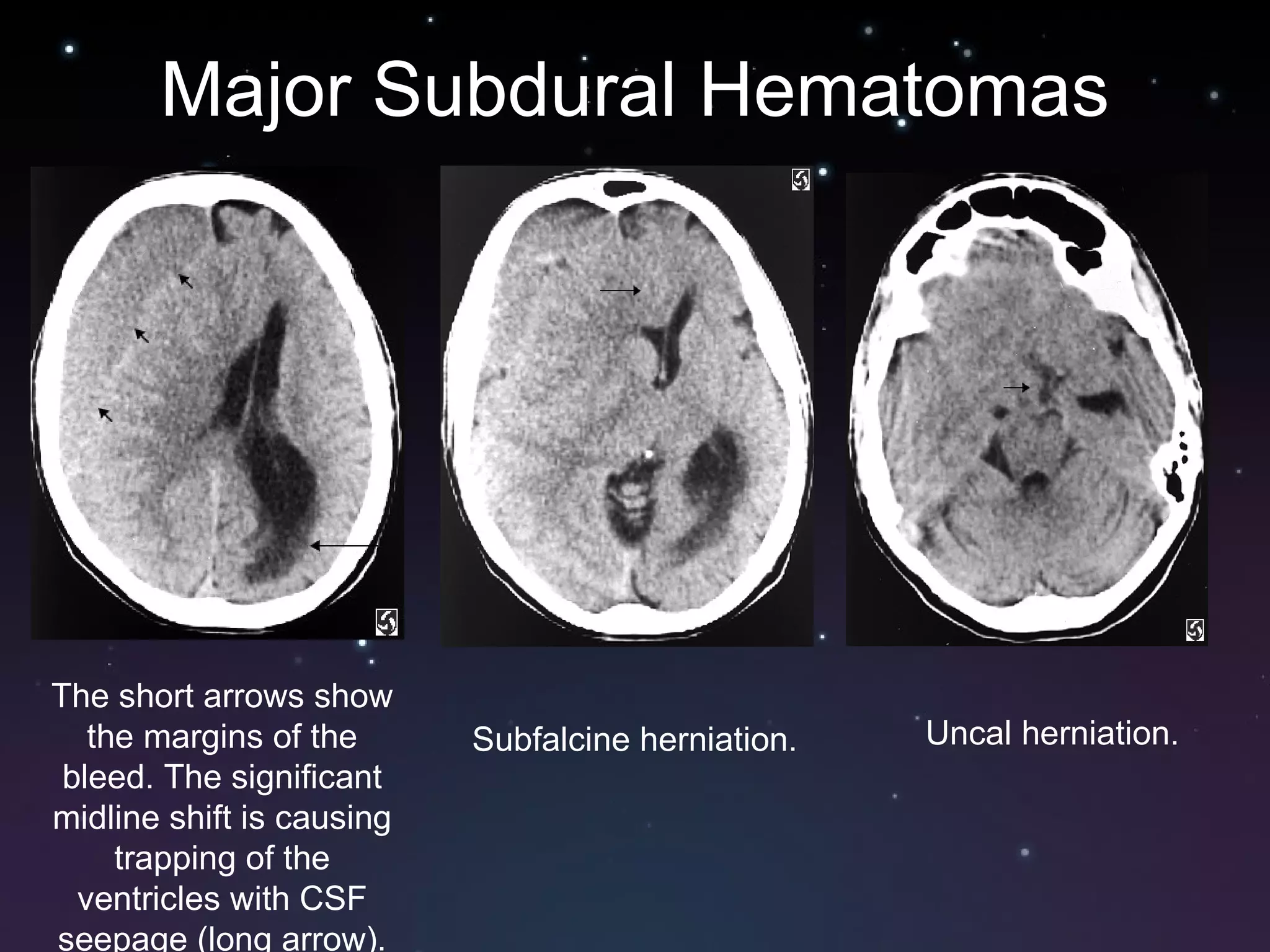 Subdural And Epidural Hematomas | PPT
