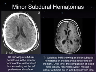 Subdural And Epidural Hematomas | PPT