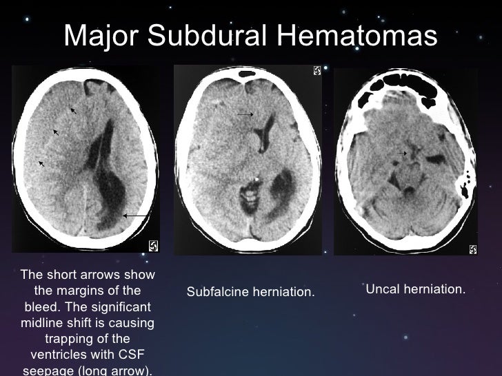 Subdural And Epidural Hematomas