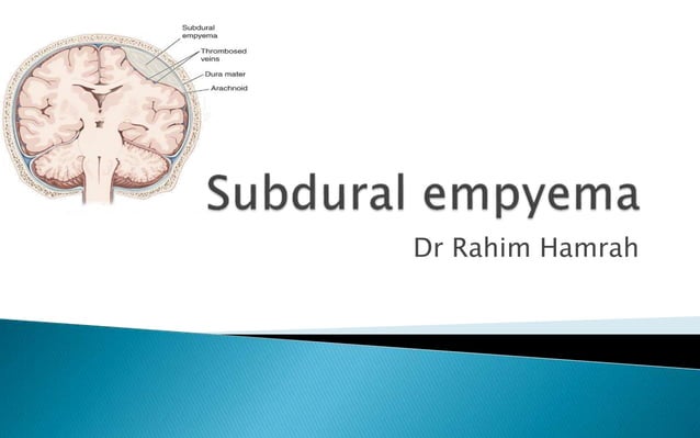 Subdural empyema | PPTX