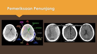 Subdural hematoma | PPTX