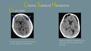 Chronic Subdural hematoma | PPTX