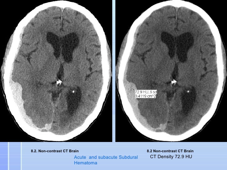 Subdural Hematoma