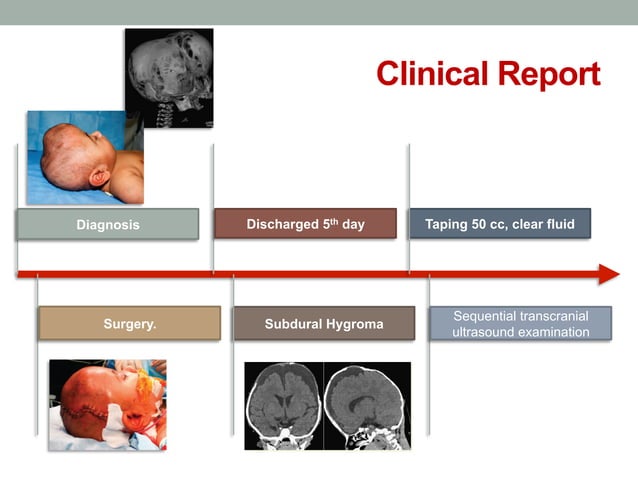 Subdural hygroma after craniosynostosis remodelling surgery | PPT
