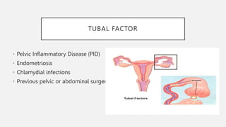 Subfertility | PPTX