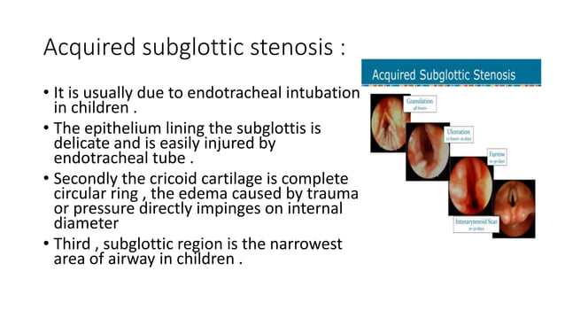 SUBGLOTTIC STENOSIS.pptx | Ear, Nose and Throat Conditions | Diseases ...