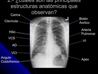 Caso 1 Torax II | PPT