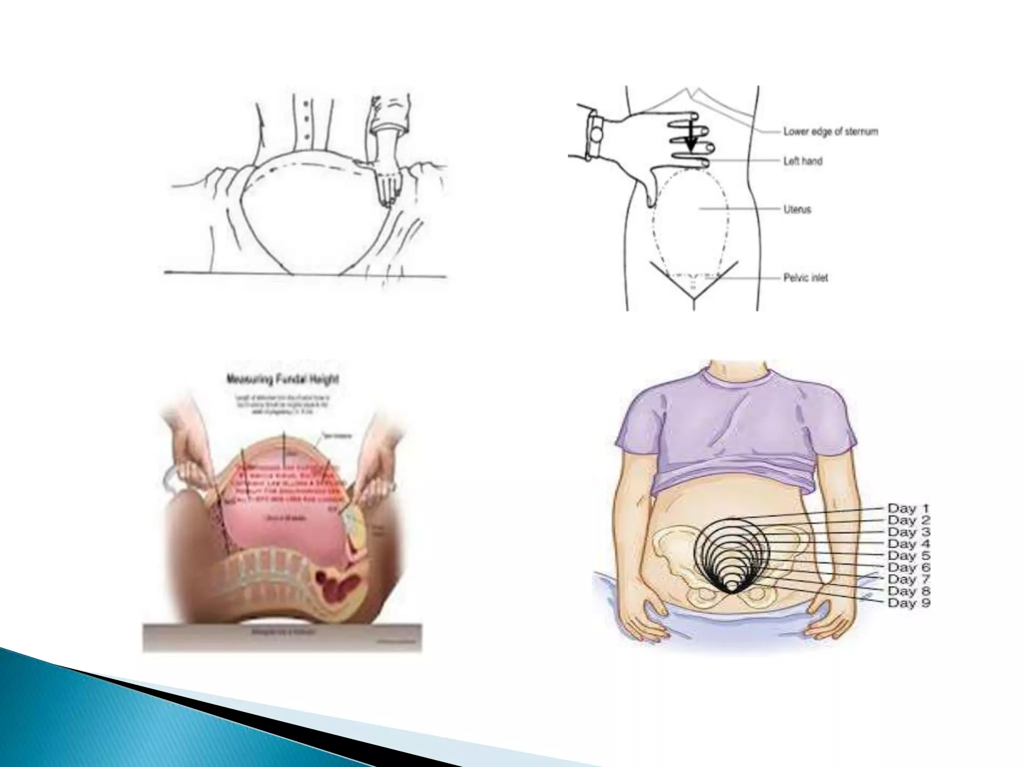 Subinvolution of the uterus | PPTX