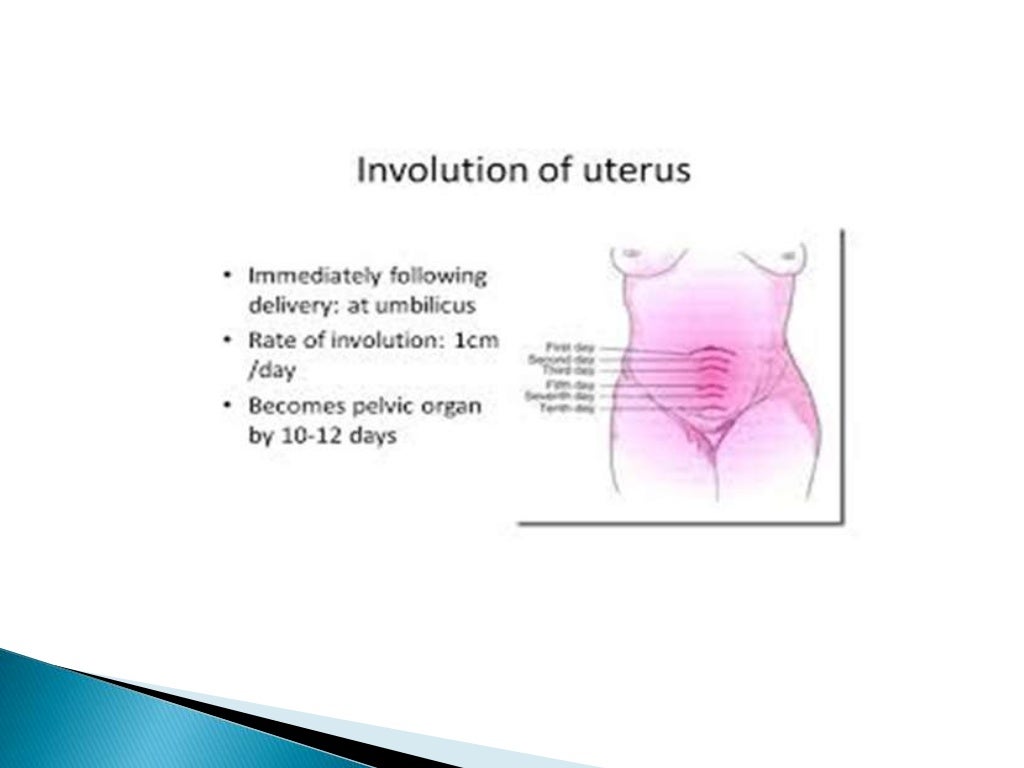 Subinvolution Of The Uterus
