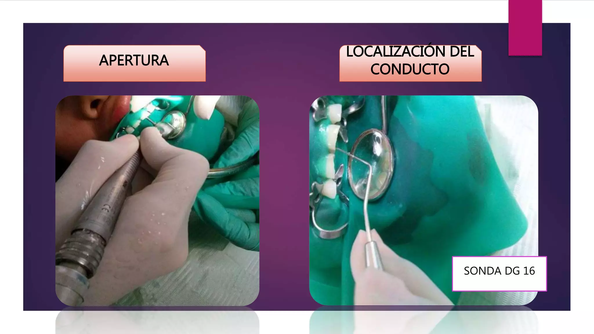 CASO CLINICO DE UN ABSCESO ALVEOLAR AGUDO | PPTX