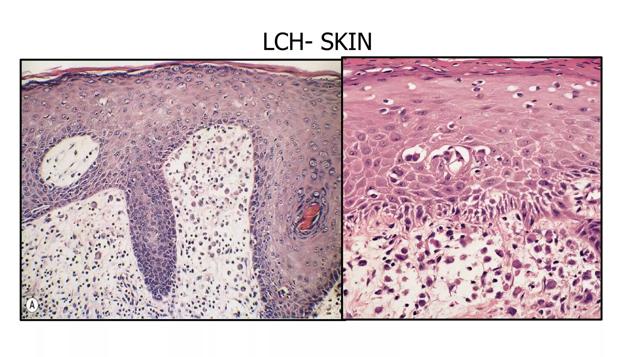 DENDRITIC CELL TUMORS PATHOLOGY | PPTX