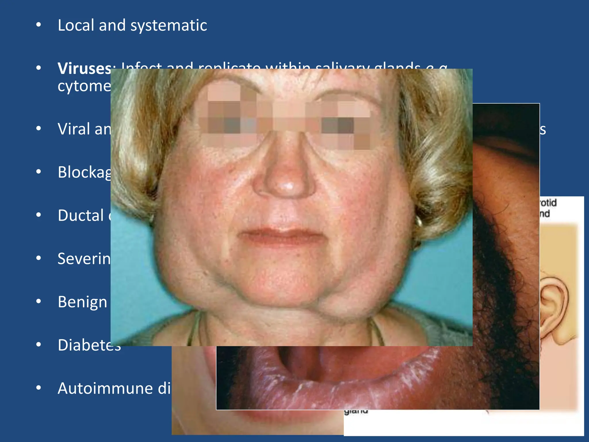 SUBLINGUAL SALIVARY GLANDS.pptx