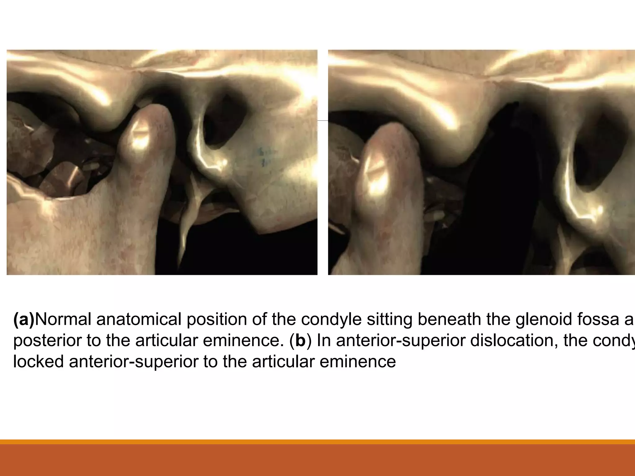 Subluxation and dislocation of temporo mandibular joint | PPTX