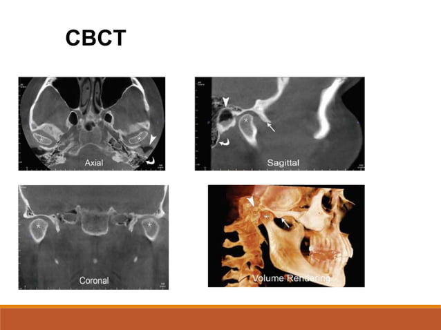 Subluxation and dislocation of temporo mandibular joint | PPTX