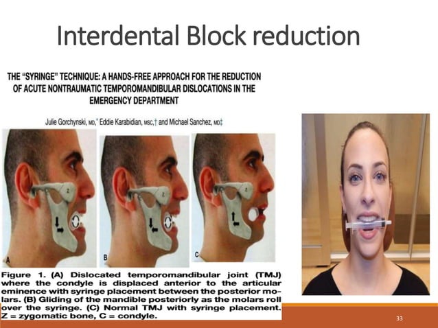 Subluxation and dislocation of temporo mandibular joint | PPTX
