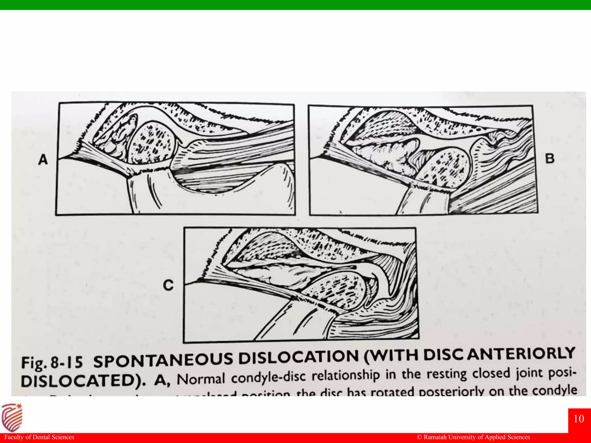 Subluxation and dislocation of temporomandibular joint | PPTX