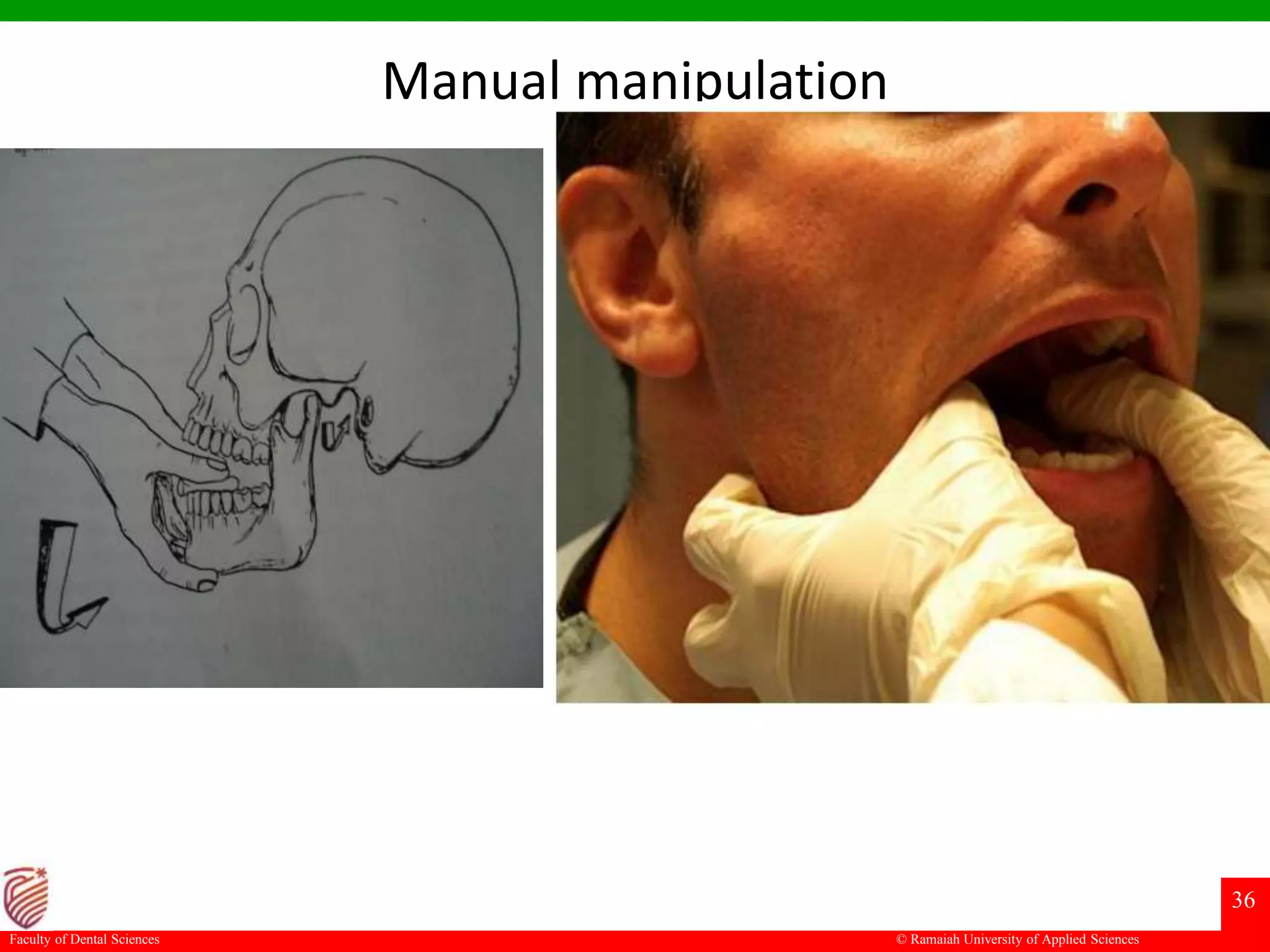 Subluxation and dislocation of temporomandibular joint | PPTX