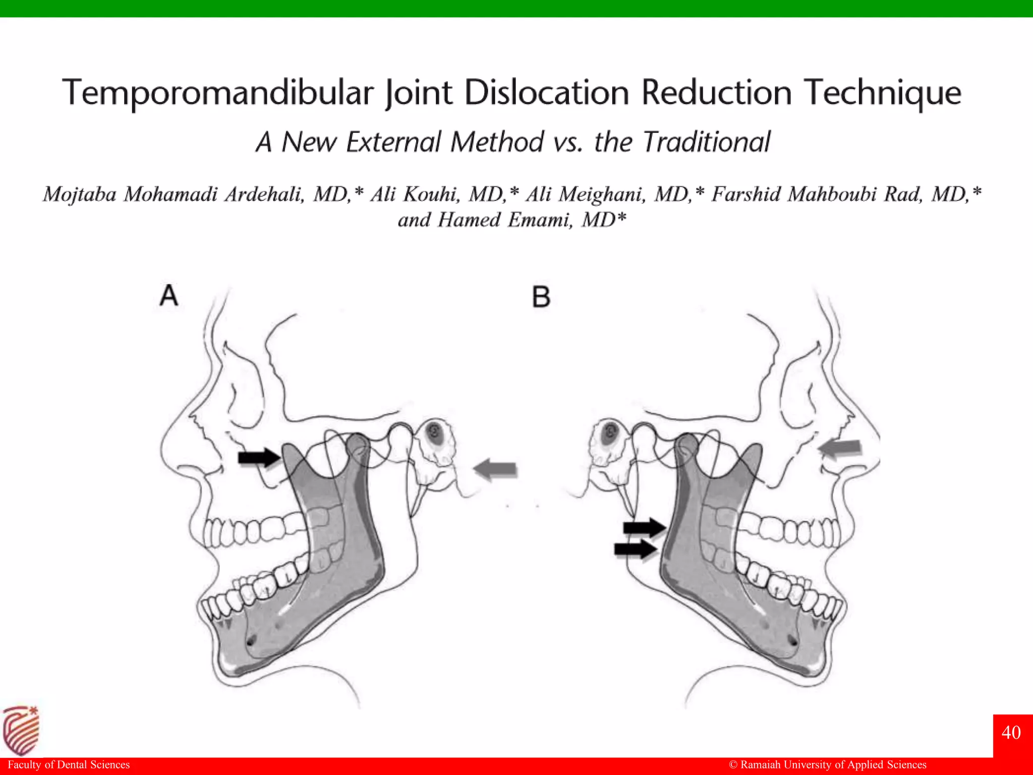 Subluxation and dislocation of temporomandibular joint | PPTX