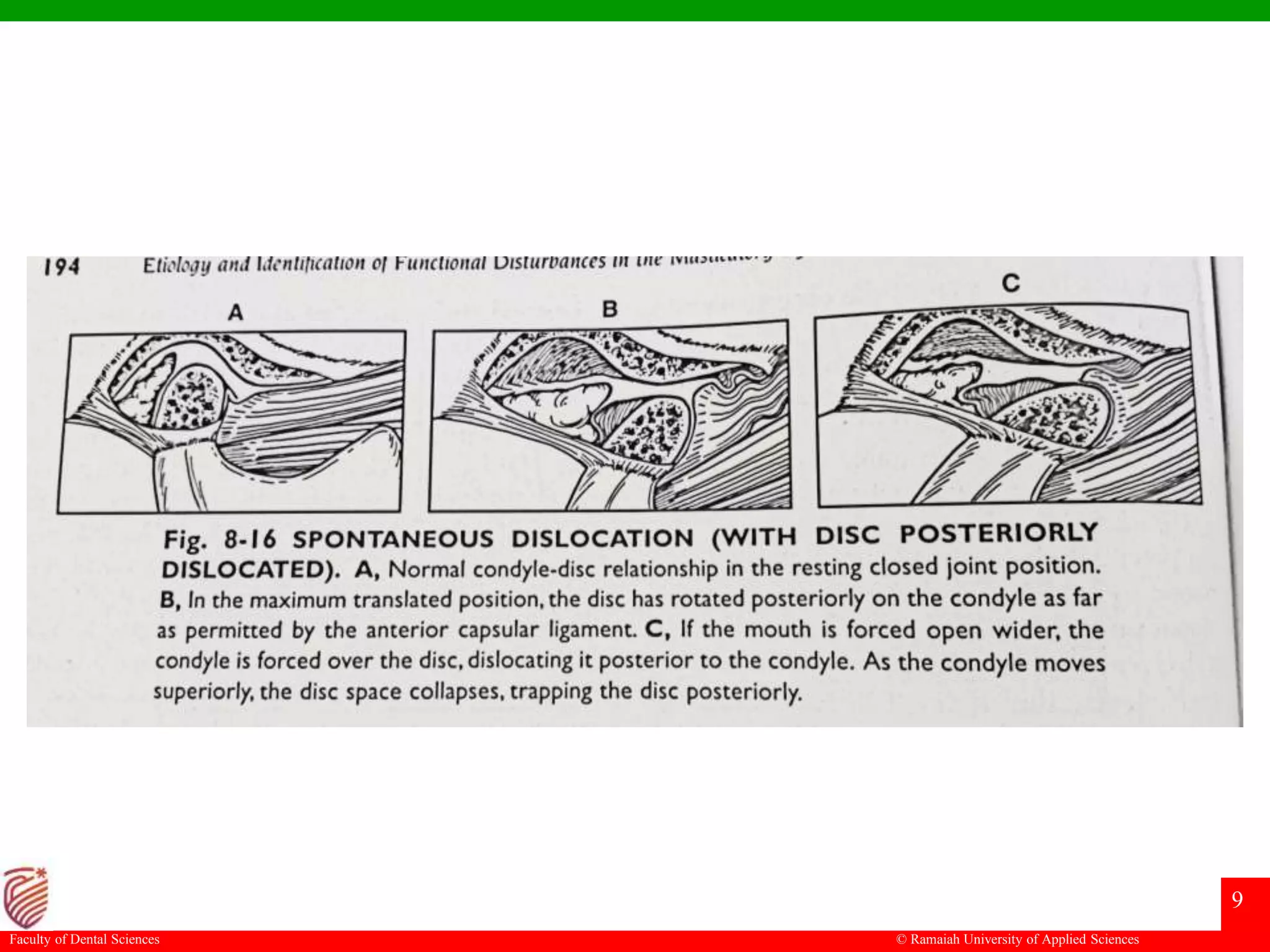 Subluxation and dislocation of temporomandibular joint | PPTX
