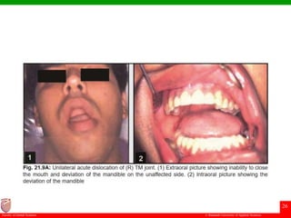 Subluxation and dislocation of temporomandibular joint | PPTX