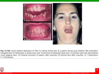 Subluxation and dislocation of temporomandibular joint | PPTX