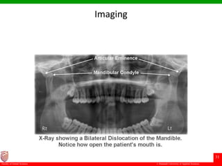 Subluxation and dislocation of temporomandibular joint | PPTX