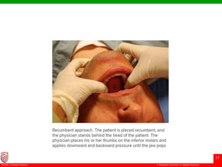 Subluxation and dislocation of temporomandibular joint | PPTX