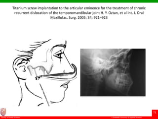 Subluxation and dislocation of temporomandibular joint | PPTX