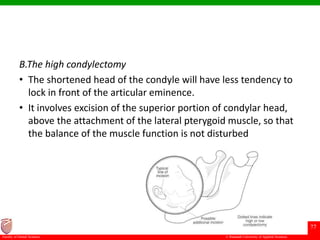Subluxation and dislocation of temporomandibular joint | PPTX
