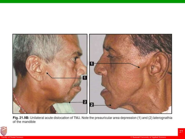 Subluxation And Dislocation Of Temporomandibular Joint Ppt