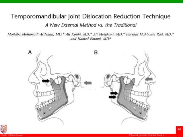 Subluxation and dislocation of temporomandibular joint