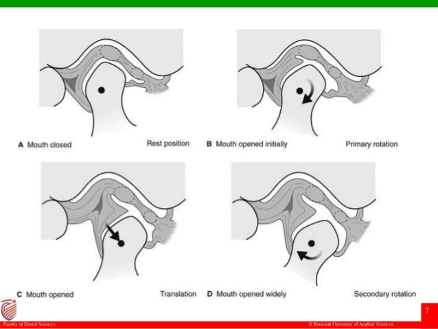 Subluxation and dislocation of temporomandibular joint
