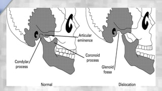 Subluxation (TMJ disorder) | PPSX