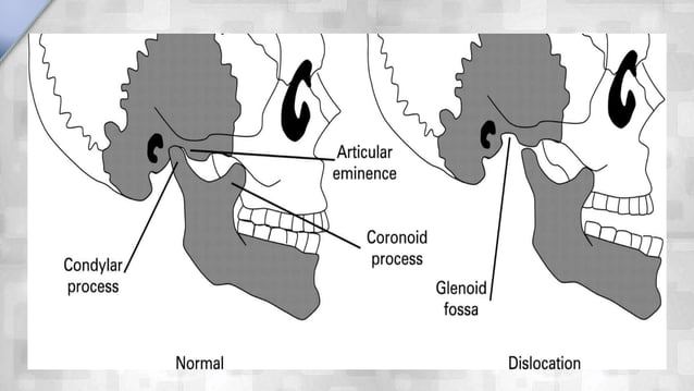 Subluxation (TMJ disorder) | PPT