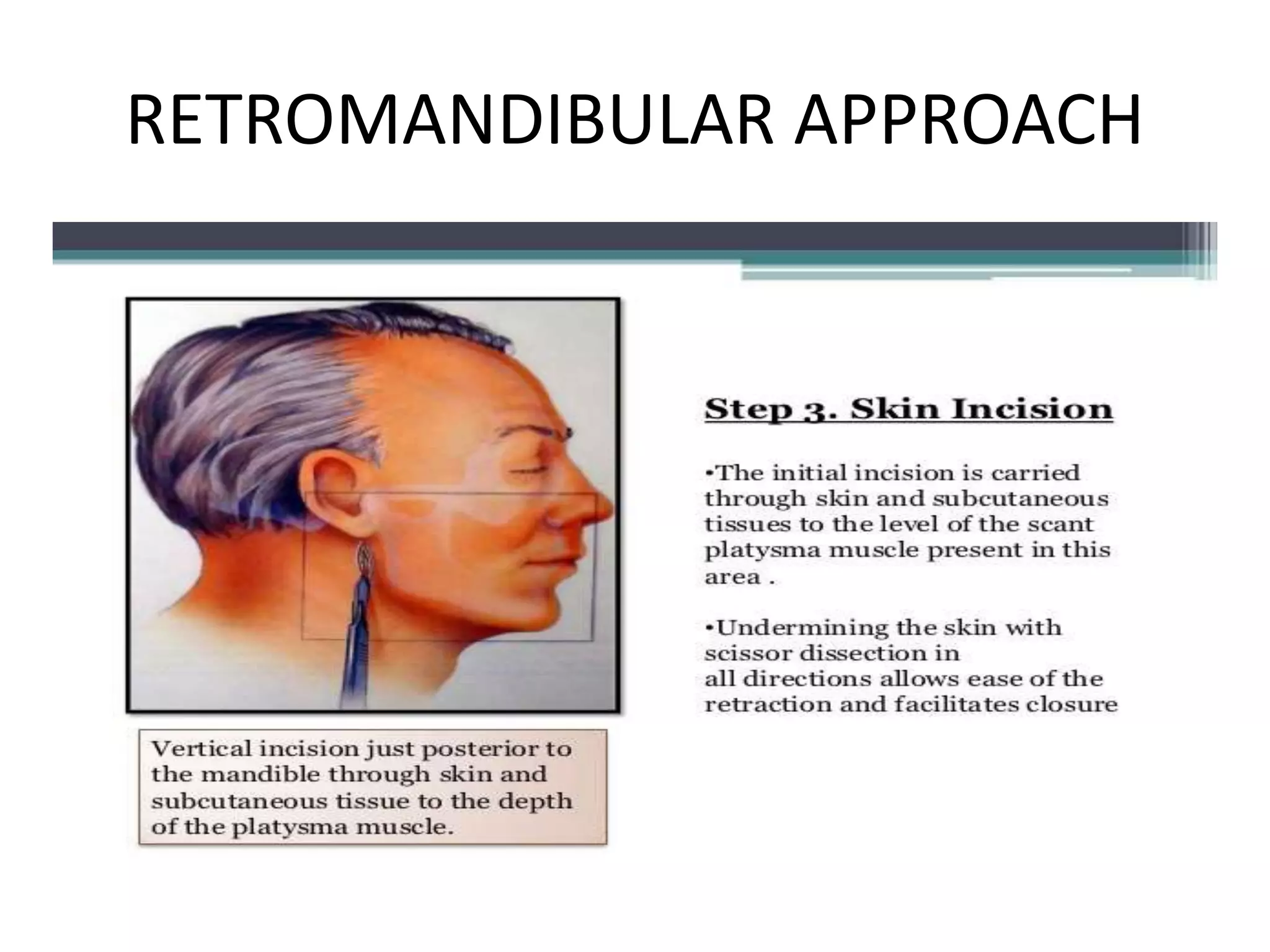 Submandibular and retromandibular approach | PPTX