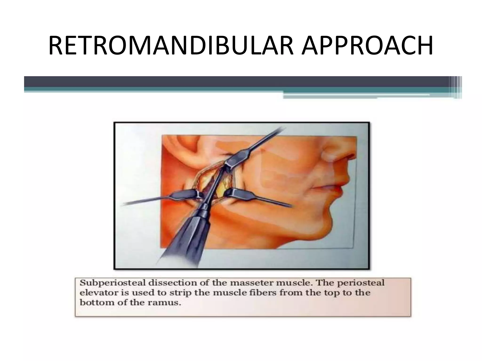 Submandibular and retromandibular approach | PPTX
