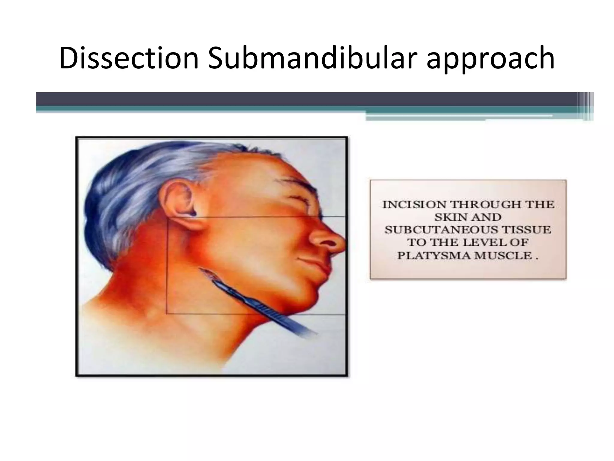 Submandibular and retromandibular approach | PPTX