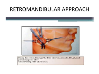 Submandibular and retromandibular approach | PPTX
