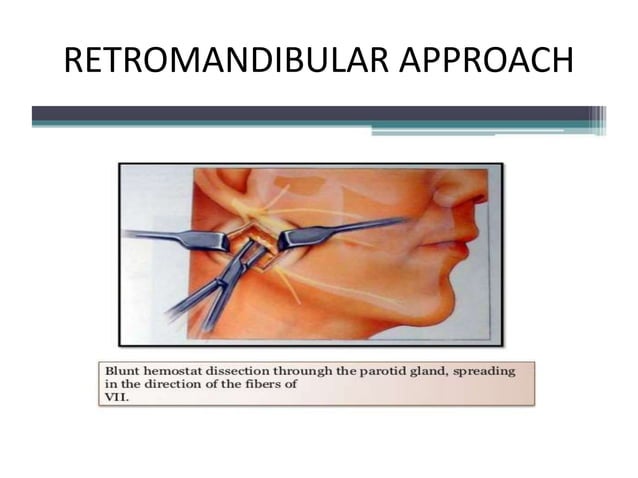 Submandibular and retromandibular approach | PPTX