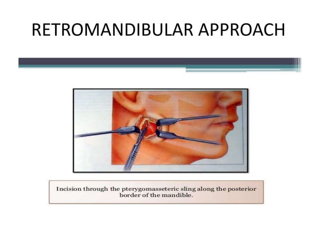 Submandibular and retromandibular approach | PPTX